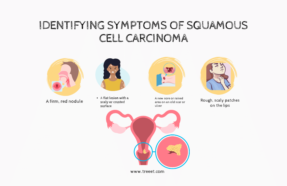 What is Squamous Cell Carcinoma - An In-depth Review 2023